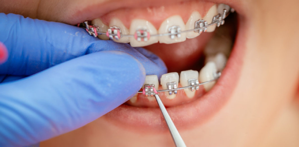 What Braces Color Should I Get Quiz Proprofs Quiz